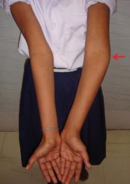 School Holidays and Broken Arms – Dr Ahmad Mahyuddin Mohamed | The ...