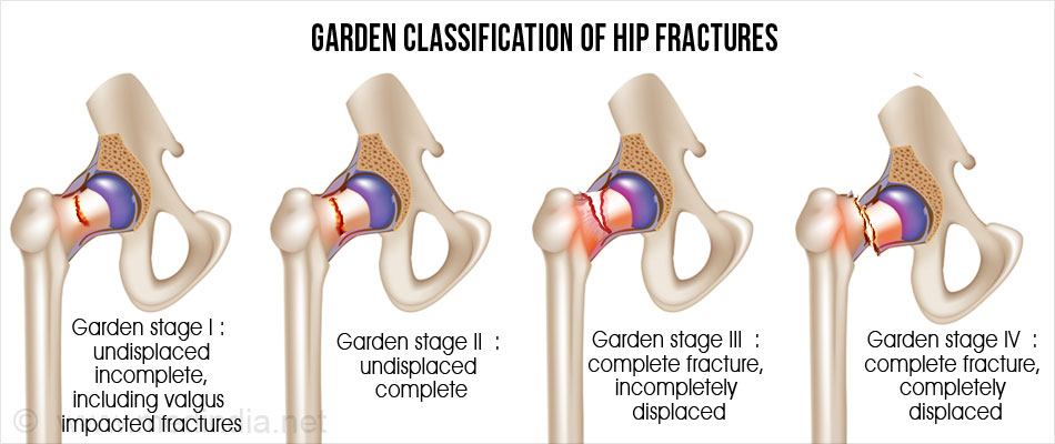 Bahaya Kepatahan Tengkuk Tulang Peha (Fracture neck of femur) – Dr ...