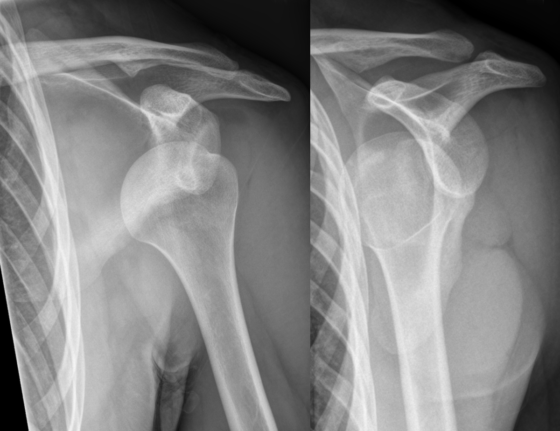 Sendi bahu terkeluar! (Shoulder dislocation) – Dr Mahyuddin Mohamed ...